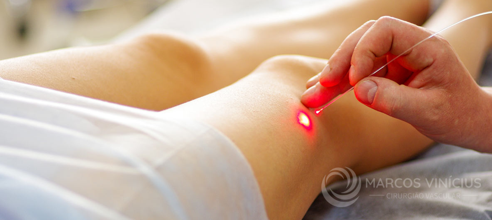 Tratamento a Laser para Varizes e Vasinhos | Dr. Marcos Vinicius